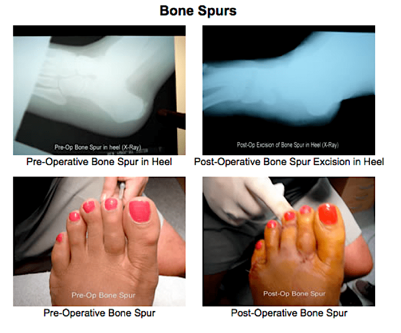 Bone Spurs Bone Spurs